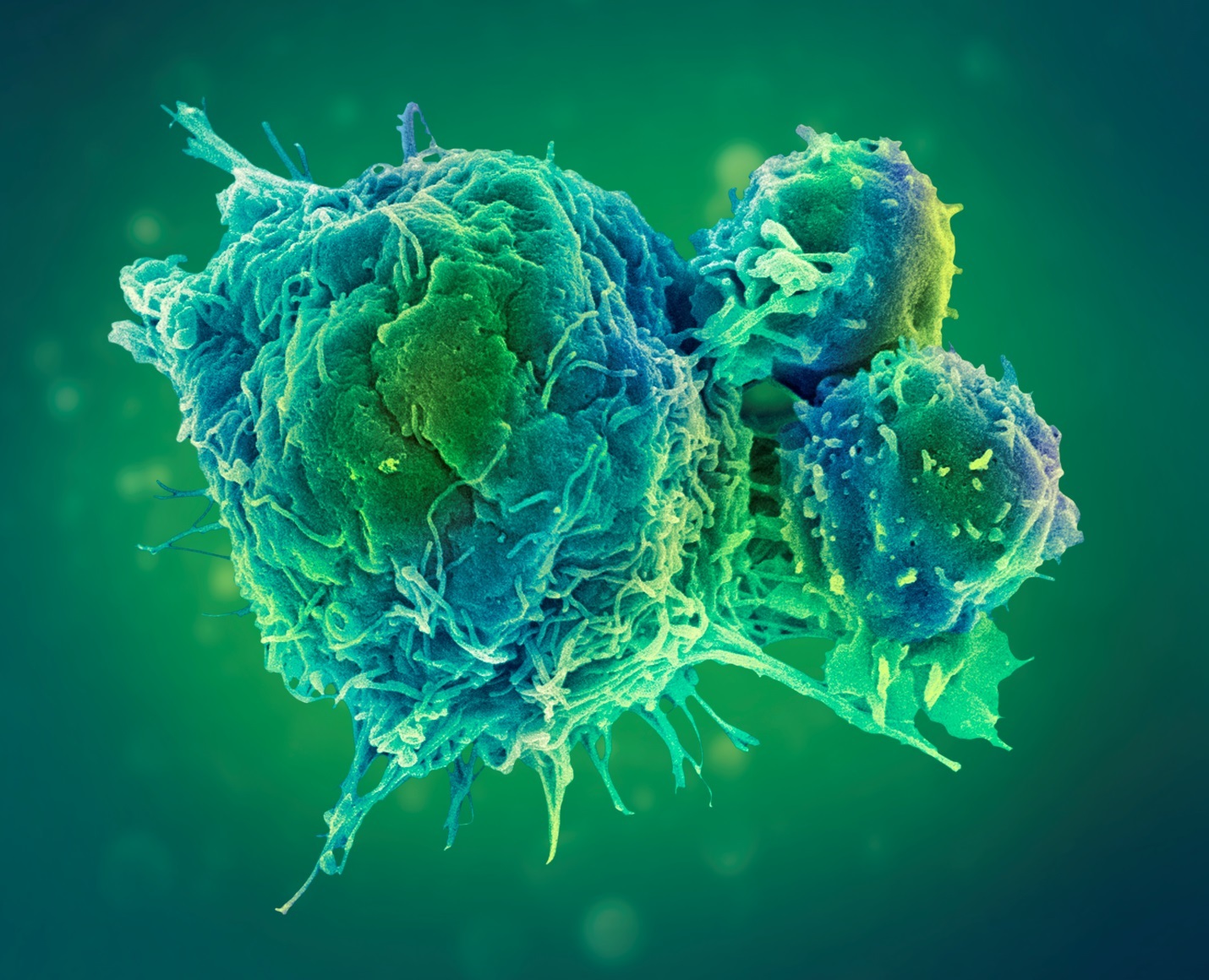 Liệu pháp miễn dịch điều trị ung thư - dấu ấn 25 năm tại Việt Nam của ...