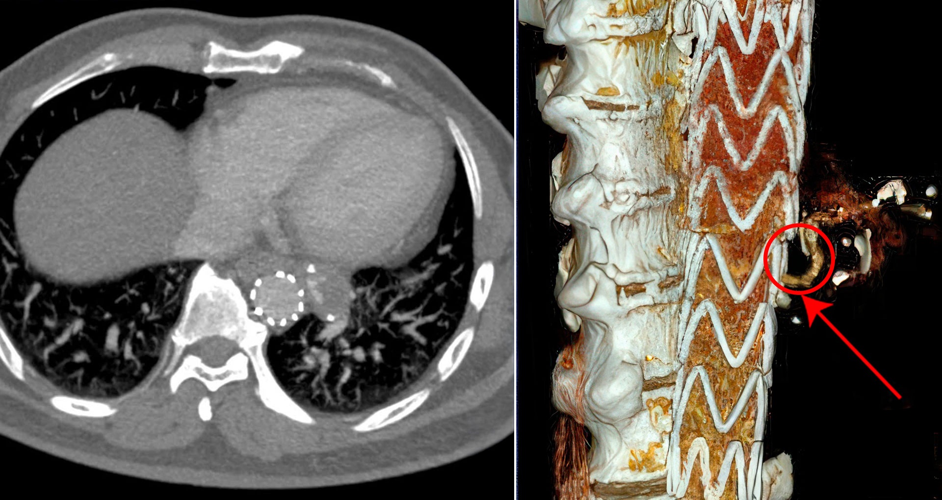 Siêu máy CT Somatom Force VB30 thế hệ mới phát hiện sớm đột quỵ, ung ...