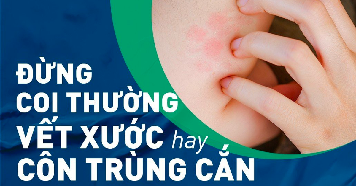 Suýt mất chân chỉ vì vết côn trùng cắn | Báo Dân trí