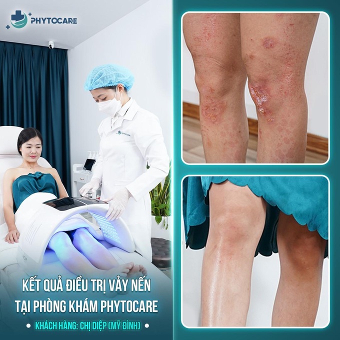 Giải pháp cho người bị viêm da cơ địa, vảy nến | Báo Dân trí