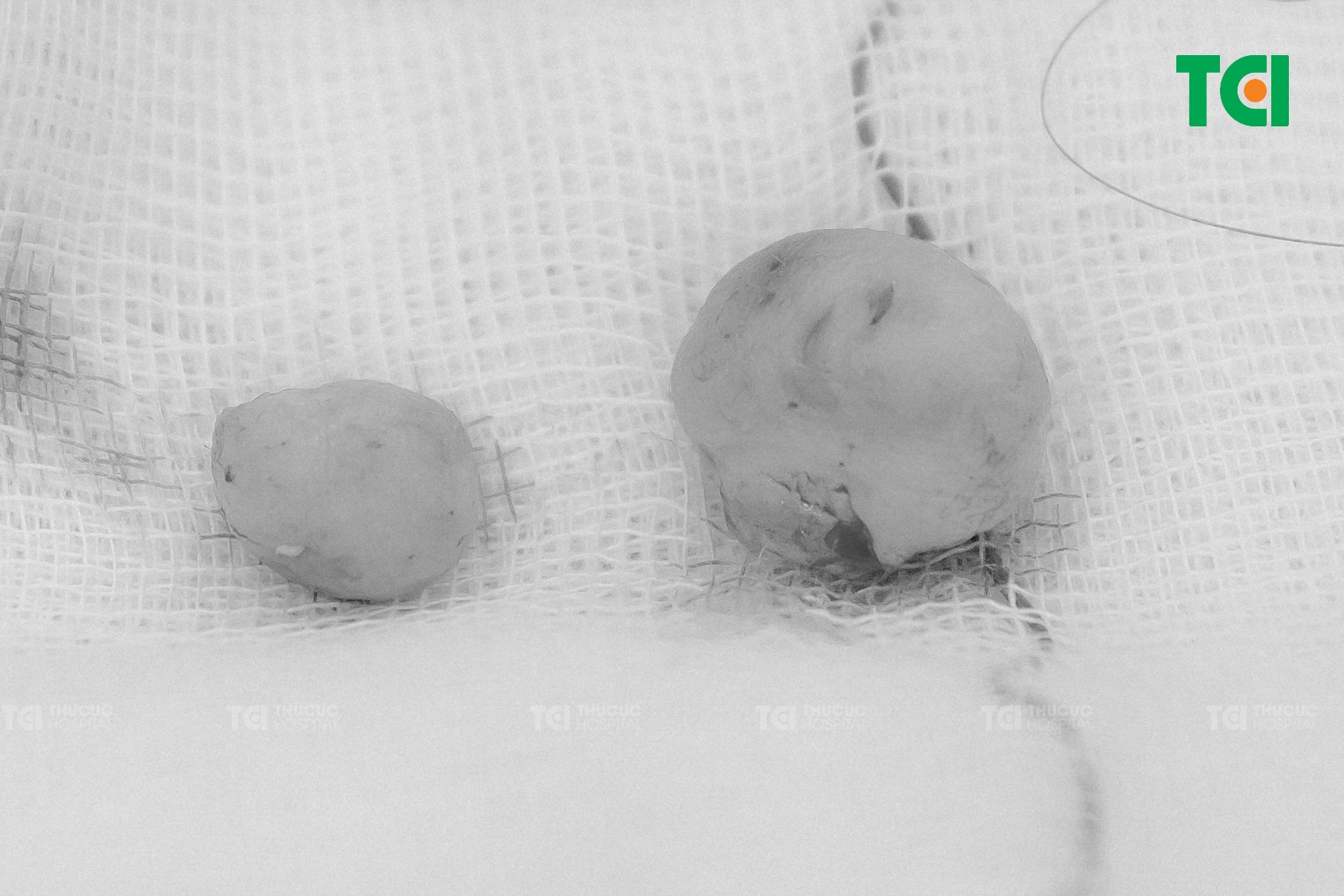 Bump lỗ xỏ khuyên: Cẩn trọng nguy cơ biến dạng tai nghiêm trọng | Báo ...